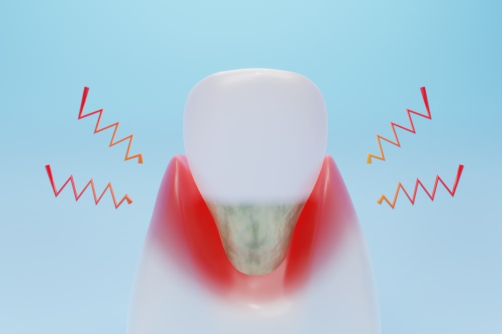 Pourquoi ai-je une récession gingivale ? | Centre Dentaire GK